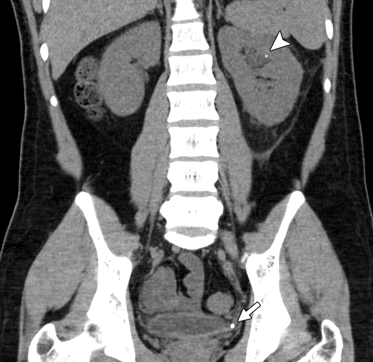 Imaging Urinary Stone Disease: New Concepts - TheSynapse