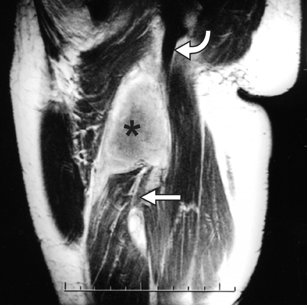 Imaging Hamstring Injury - TheSynapse
