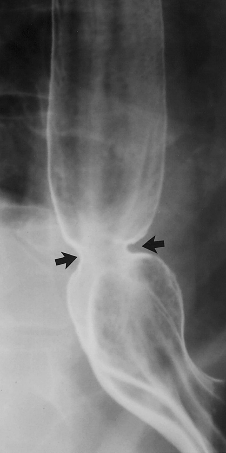 Imaging Oesophageal Cancer - TheSynapse