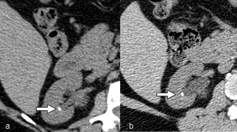 Imaging Urinary Stone Disease: New Concepts - TheSynapse