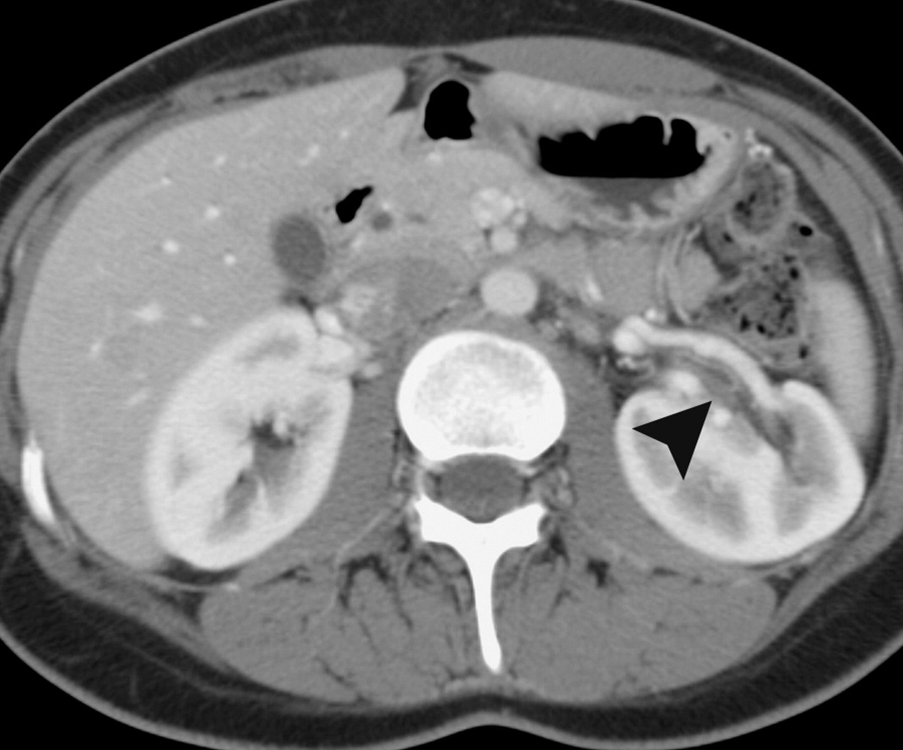 Imaging Pyelonephritis – Part I - TheSynapse