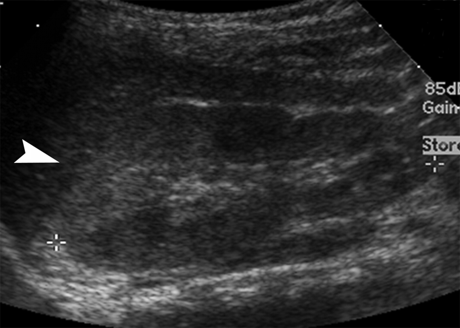 Imaging Pyelonephritis – Part I - TheSynapse