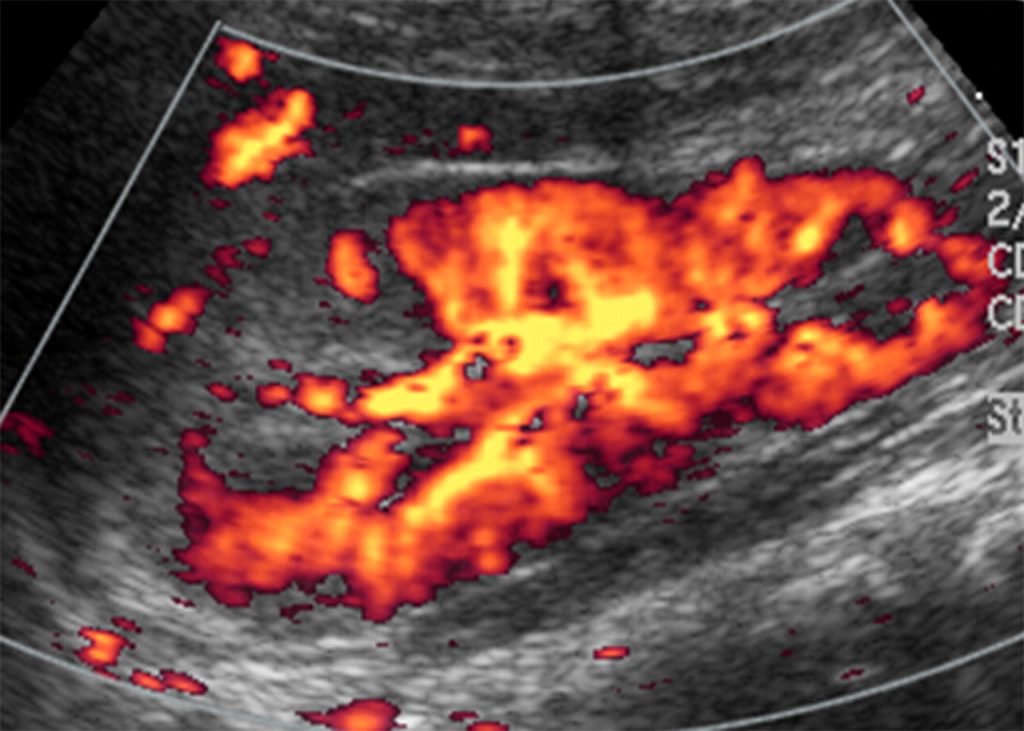 Imaging Pyelonephritis – Part I - TheSynapse