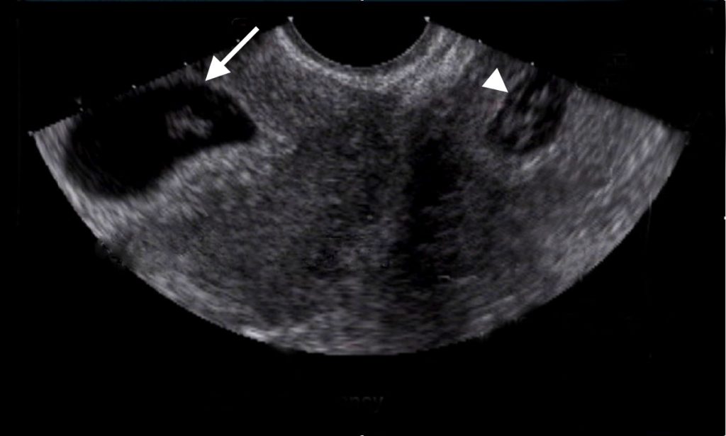 Ultrasound Diagnosis and Management of Ectopic Pregnancy - TheSynapse
